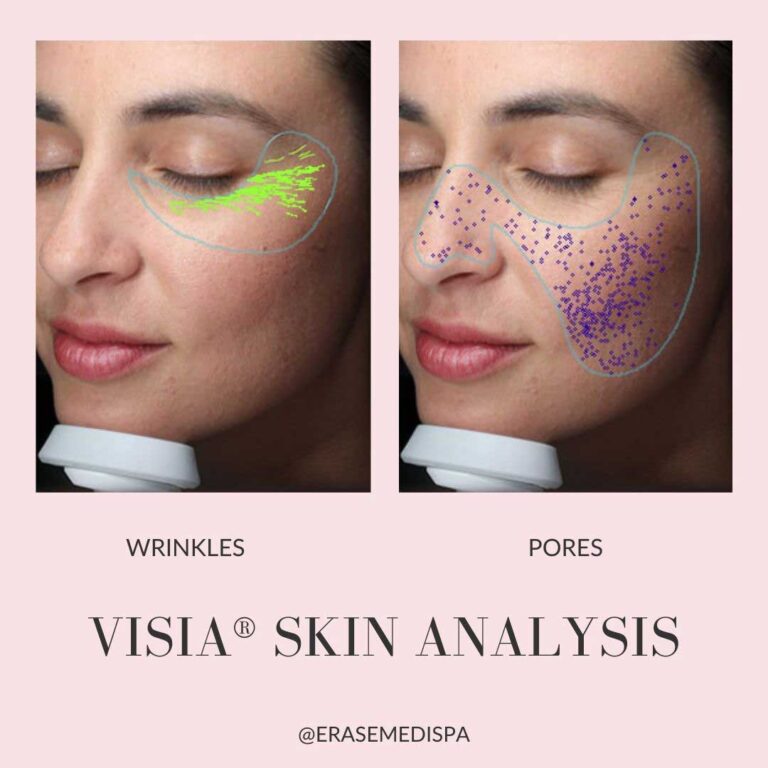 VISIA Skin Analysis Lake Forest, IL | Skin Complexion Analysis